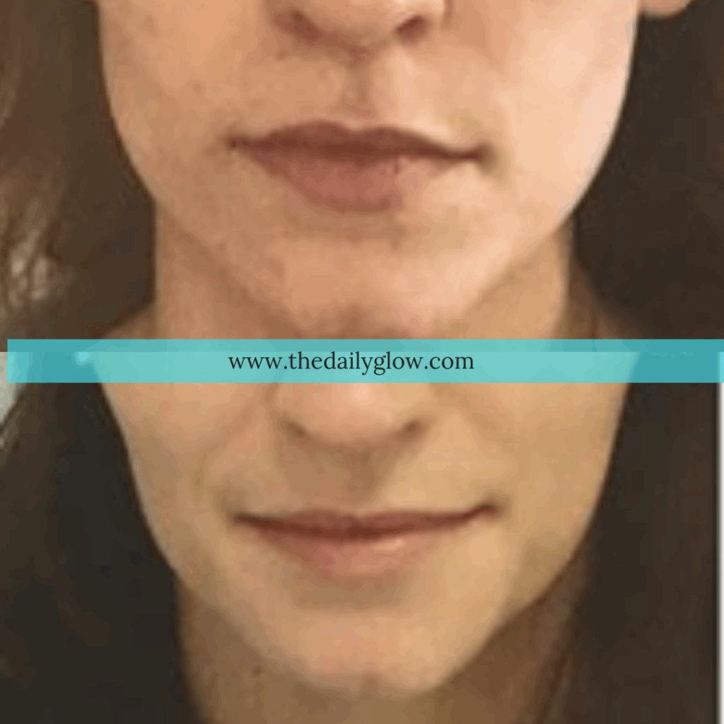 Botox and teeth grinding...what's the deal? - The Glow Clinic